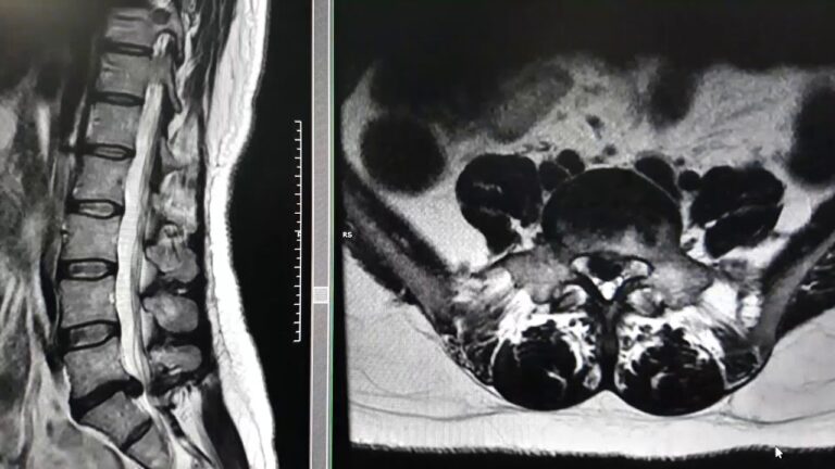 Descubre cómo se visualiza una hernia discal en una radiografía: Todo ...