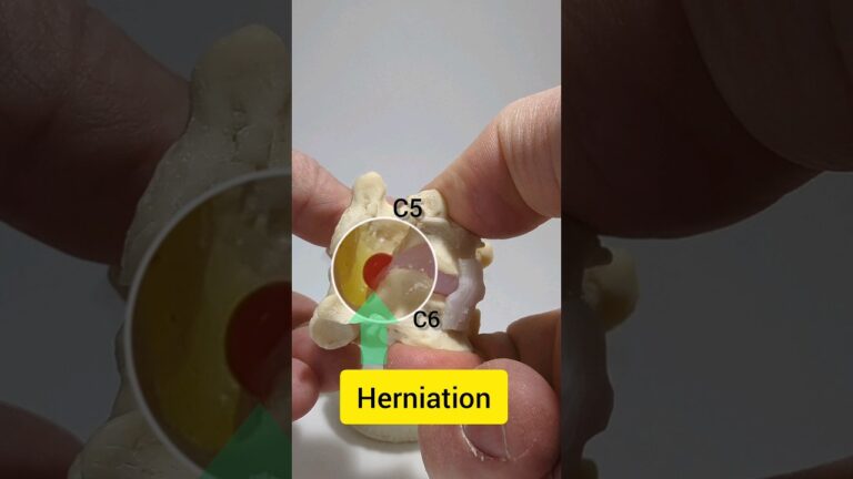 Protrusión posterior del disco C5 C6: Causas, síntomas y tratamientos ...